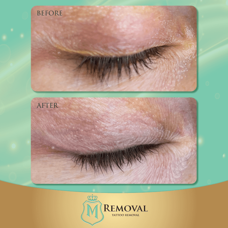 Curso de Eliminación de Tatuajes Online - MRemoval